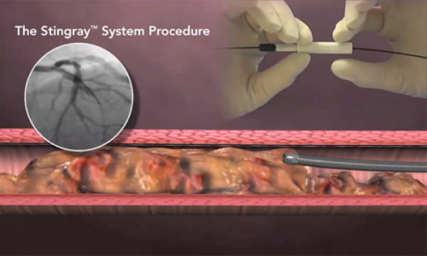 Coronary Chronic Total Occlusion (CTO) System | Boston Scientific