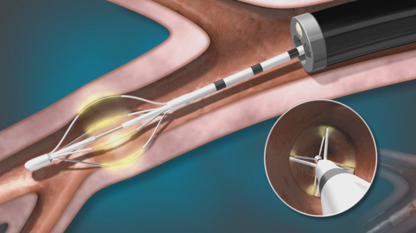 Bronchial Thermoplasty - Boston Scientific