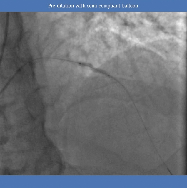 FFR guided PCI with new Comet™ FFR Pressure guidewire reveals the true ...