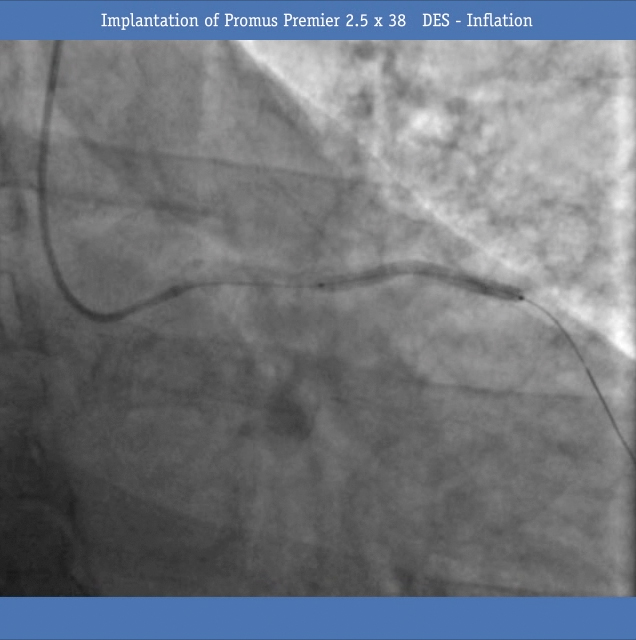 FFR guided PCI with new Comet™ FFR Pressure guidewire reveals the true ...