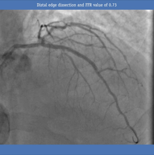 FFR guided PCI with new Comet™ FFR Pressure guidewire reveals the true ...