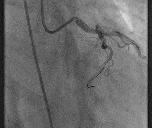 FFR simplifies treatment strategy - Boston Scientific