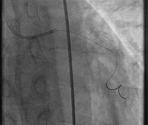 FFR simplifies treatment strategy - Boston Scientific