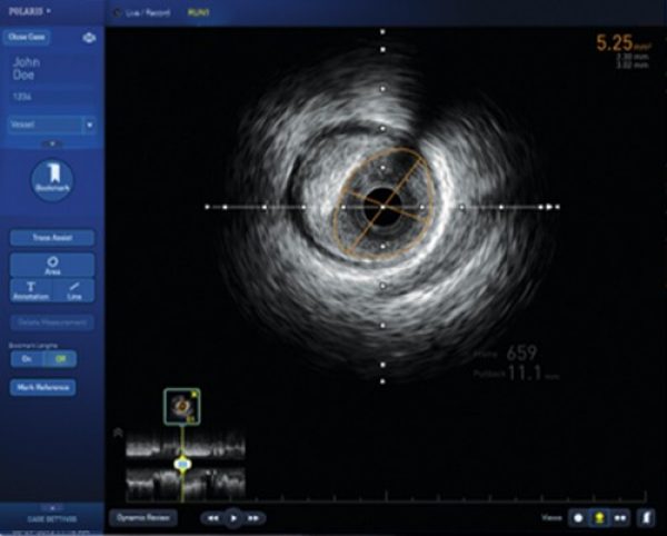 POLARIS - PCI Guidance Products & Programs - Boston Scientific
