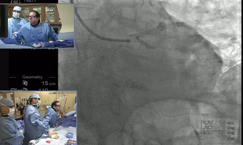 Complex PCI - Boston Scientific