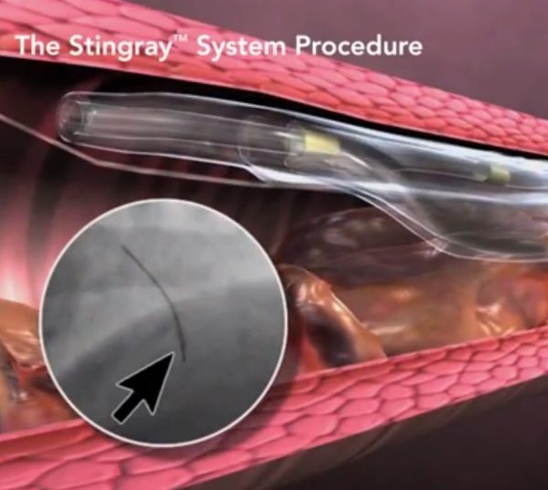 Coronary Chronic Total Occlusion (CTO) System - Boston Scientific