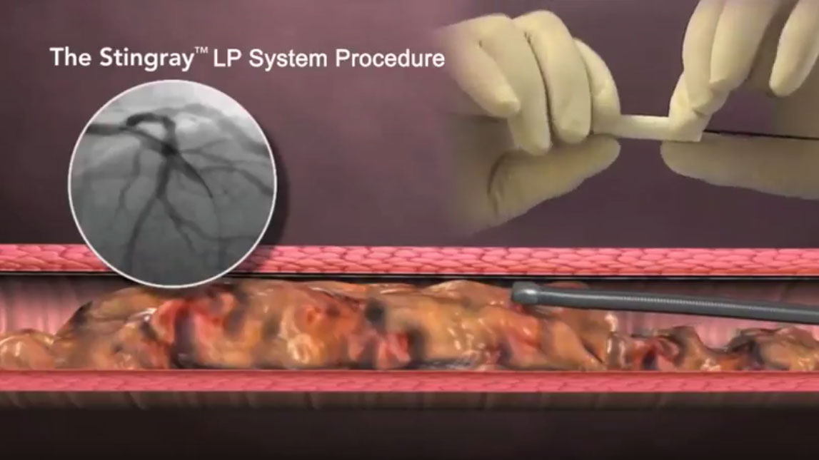 Coronary Chronic Total Occlusion (CTO) System - Boston Scientific