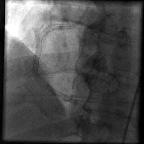 ANGIOJET™ Ultra Coronary Thrombectomy System - Boston Scientific
