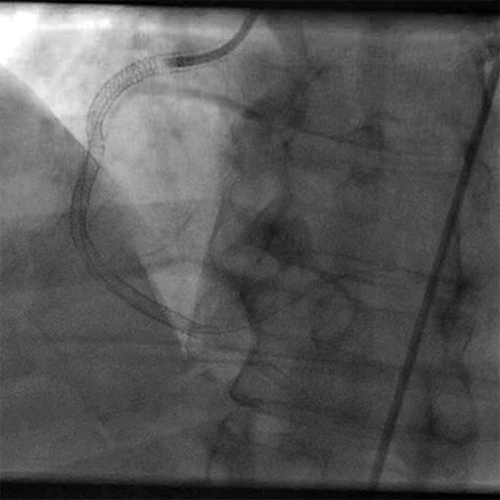 ANGIOJET™ Ultra Coronary Thrombectomy System - Boston Scientific