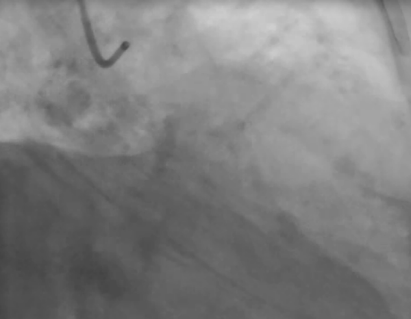 Workhorse-like FFR wire assesses complex case with 90° angle - Boston ...