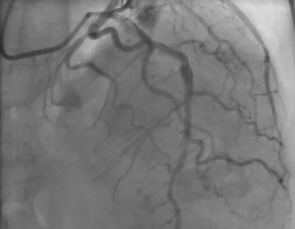 Workhorse-like FFR wire assesses complex case with 90° angle - Boston ...