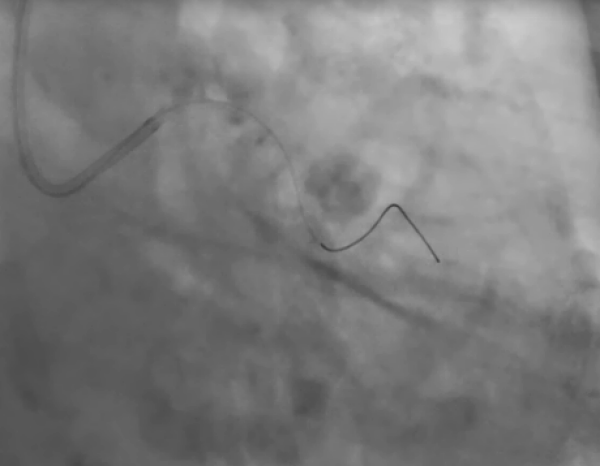 Workhorse-like FFR wire assesses complex case with 90° angle - Boston ...