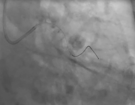 Workhorse-like FFR wire assesses complex case with 90° angle - Boston ...