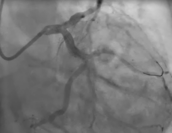 Workhorse-like FFR wire assesses complex case with 90° angle - Boston ...