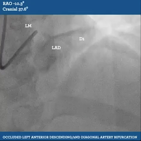 Complex bifurcation disease - Boston Scientific