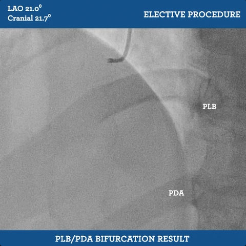 Complex bifurcation disease - Boston Scientific