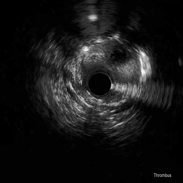 Complex PCI IVUS Catheter – OPTICROSS HD - Boston Scientific
