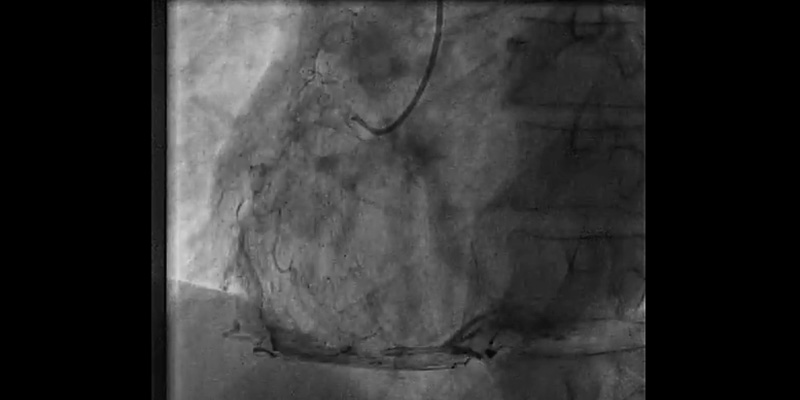 Rotablation and Cutting Balloon® as complementary techniques in the ...