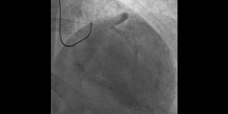 Rotablation and Cutting Balloon® as complementary techniques in the ...