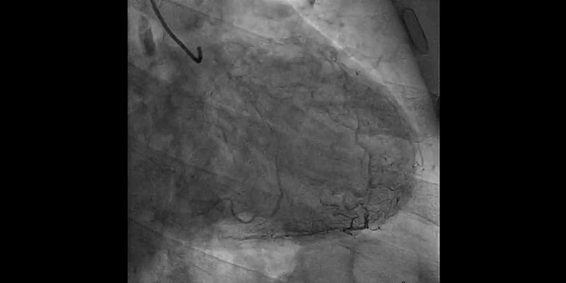 Rotablation and Cutting Balloon® as complementary techniques in the ...