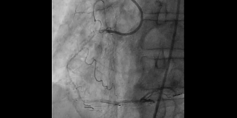 Rotablation and Cutting Balloon® as complementary techniques in the ...