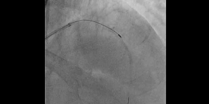 Rotablation and Cutting Balloon® as complementary techniques in the ...