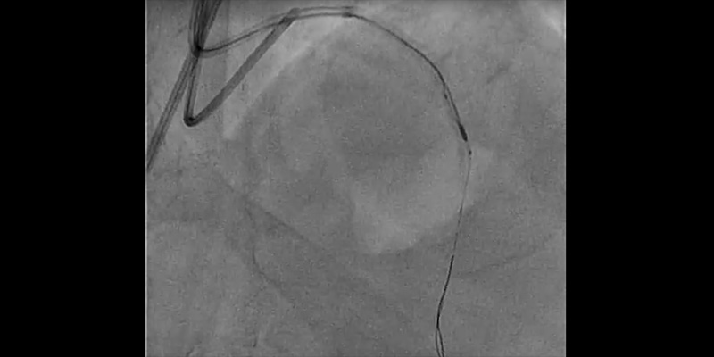 Rotablation and Cutting Balloon® as complementary techniques in the ...