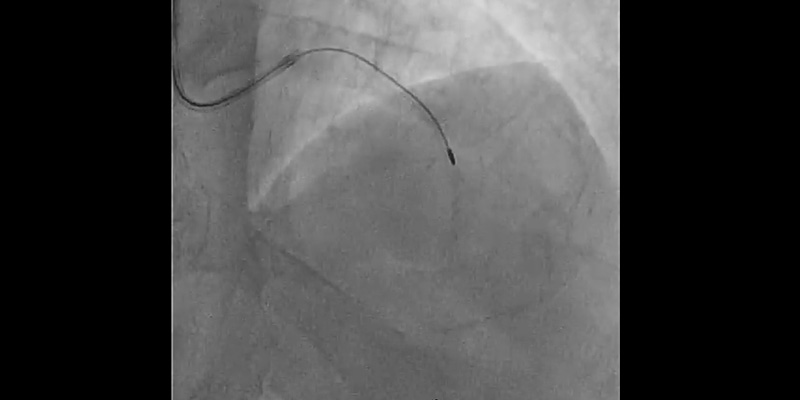 Rotablation and Cutting Balloon® as complementary techniques in the ...