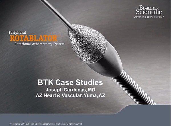 Peripheral Rotablator™ Rotational Atherectomy System | Boston Scientific
