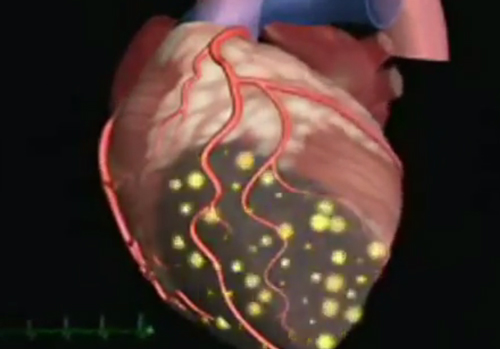 Paro Cardíaco Repentino | Boston Scientific