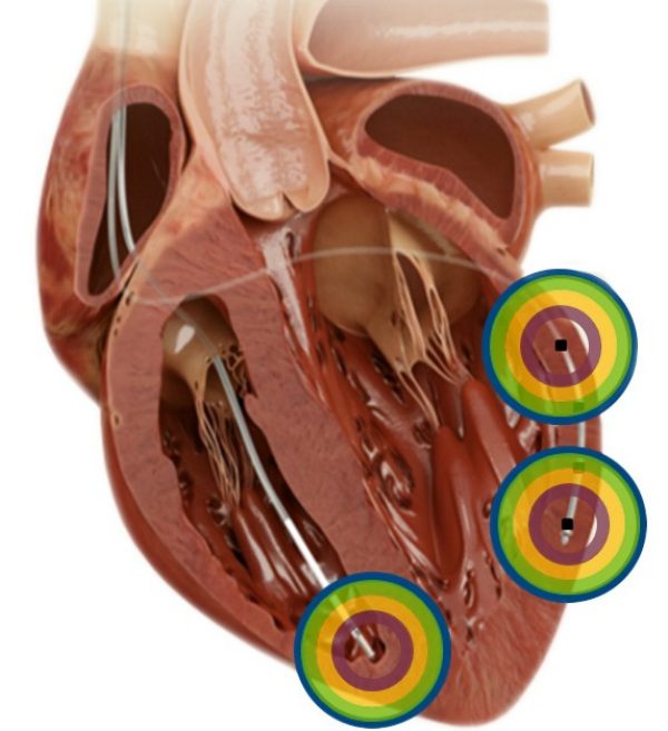 How to pace | SmartCRT - Boston Scientific