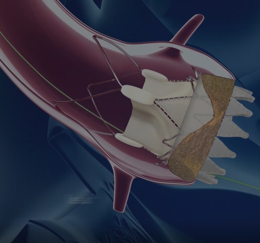 TAVI Technology - ACURATE neo2™ Aortic Valve System - Boston Scientific