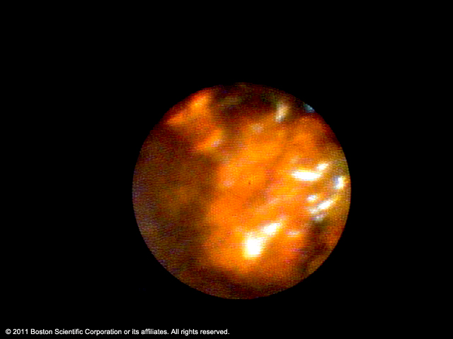 Intraductal (SpyGlass System only) Images - Boston Scientific