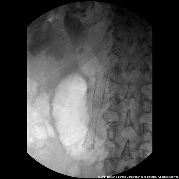 Biliary Metal Stent Images - Boston Scientific