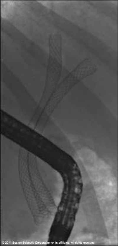 Biliary Metal Stent Images - Boston Scientific
