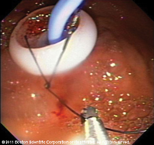 Endovive Enteral Access Device Images - Boston Scientific