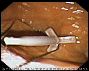 Endovive Enteral Access Device Images - Boston Scientific