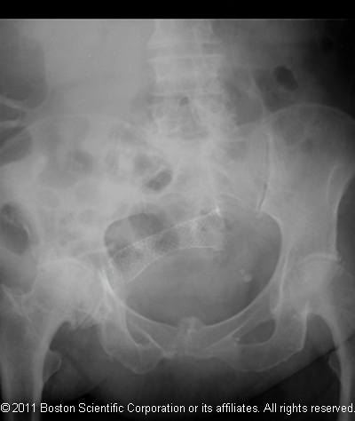 Enteral Stent Images | Boston Scientific - Boston Scientific