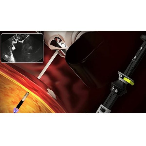 AXIOS™ Stent and Electrocautery Enhanced Delivery System - Boston ...