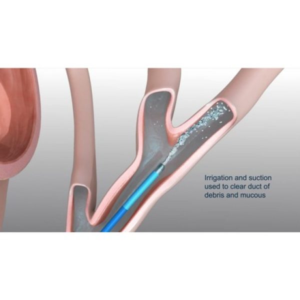 SpyGlass™ DS Direct Visualization System | Boston Scientific
