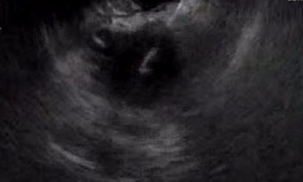 Expect™ and Expect Slimline (SL) - Boston Scientific