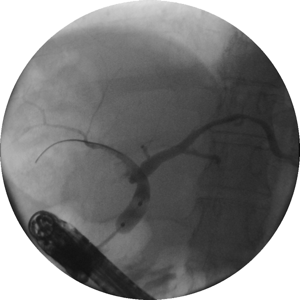 Hurricane RX Biliary Balloon Dilation Catheter - Boston Scientific