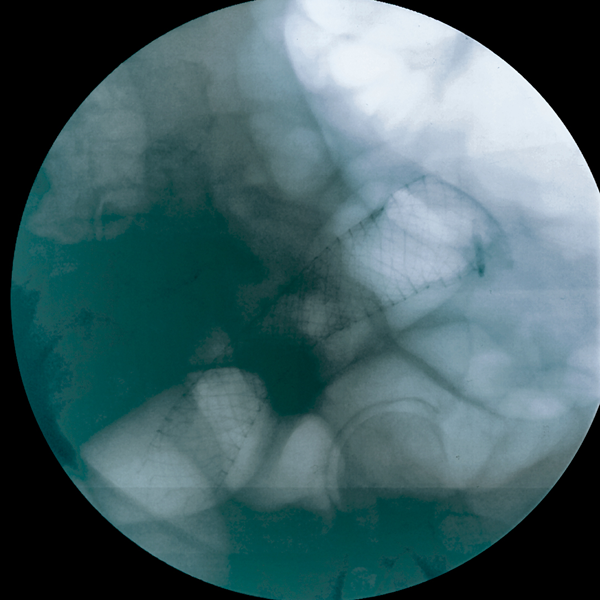 WallFlex™ Colonic Stents - Boston Scientific