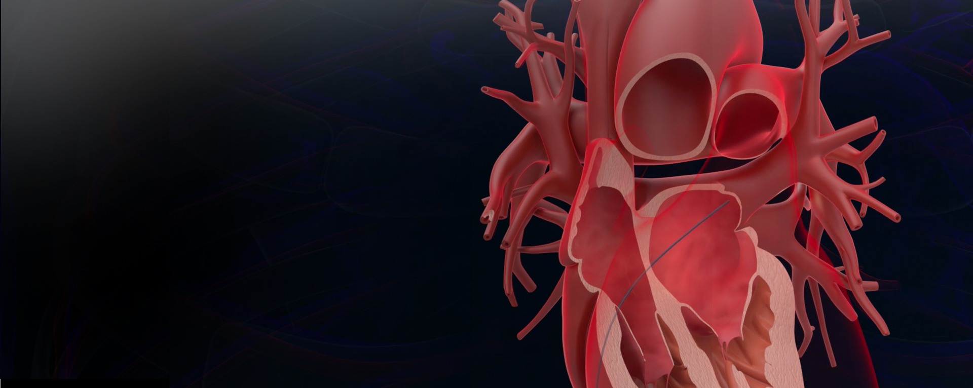 Atrial Fibrillation therapy by ablation - Boston Scientific