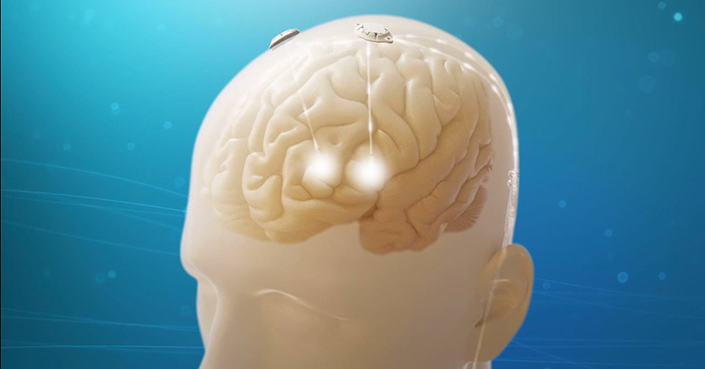 Visão geral e indicações da DBS | Boston Scientific