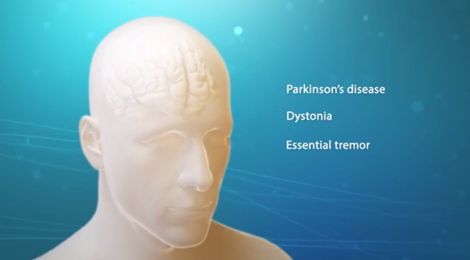 Vercise DBS System - Boston Scientific