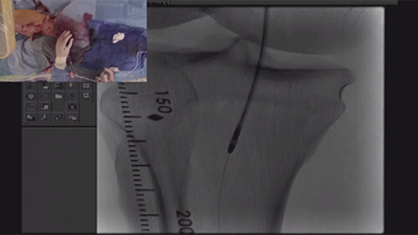 Jetstream™ Atherectomy System - Boston Scientific