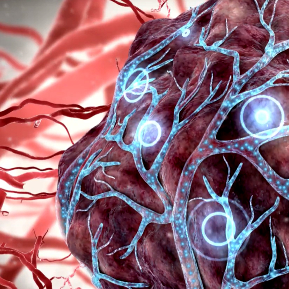 TheraSphere™ Y-90 Glass Microspheres - Boston Scientific