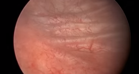 Greenlight XPS™ Laser Therapy System | Healthcare Professionals ...