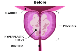Rezūm™ Water Vapor Therapy - Media Kit - Boston Scientific